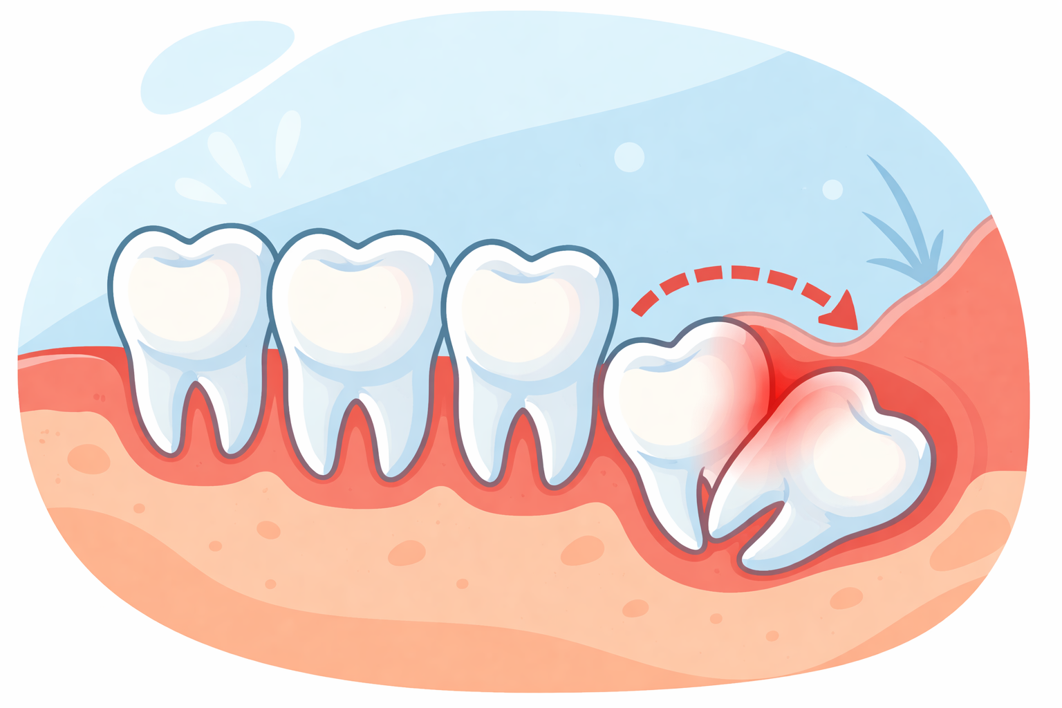 Do Wisdom Teeth Cause Crooked Teeth?